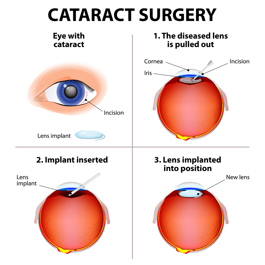 Iron Lines Corneal Eye Patient Iron Lines Corneal Eye Patient