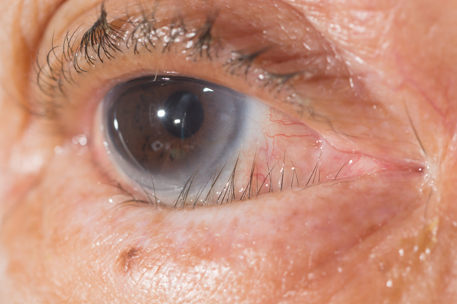 Trichiasis Eye Patient